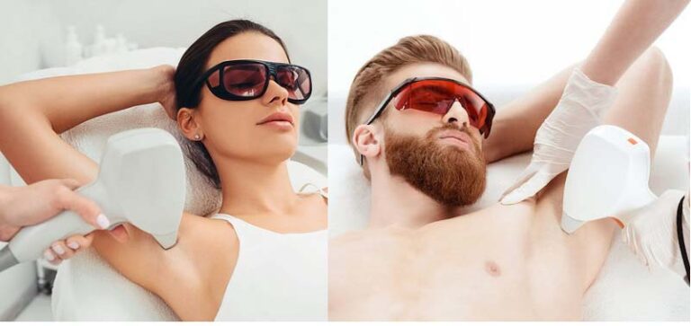 Epilare definitiva Laser